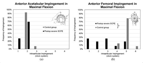 A Acetabular And B Femoral Impingement Location Is Shown In Maximal