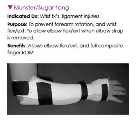 Sugar Tong Splint Surgery Hand Surgery Ocupational Therapy Occupational Therapy Schools