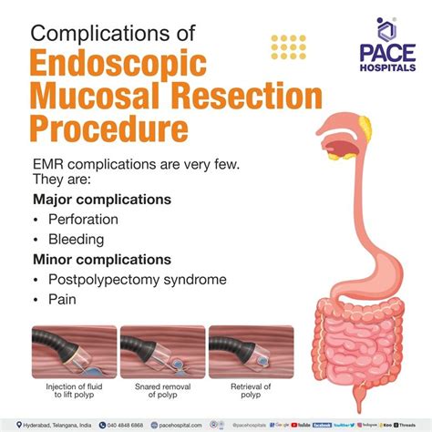 Endoscopic Mucosal Resection In Hyderabad India Indications Cost
