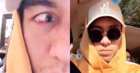 Roberto Firmino Shows Extent Of Eye Injury 10 Days After Liverpool