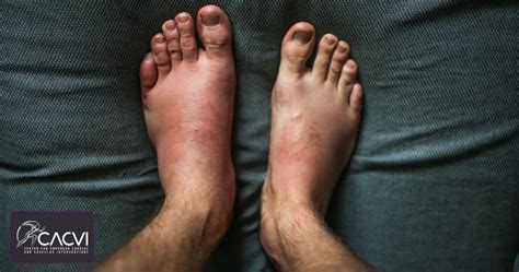 How Much Does Hemosiderin Staining Laser Treatment Cost