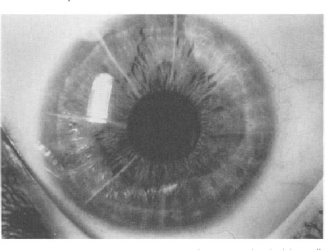 Figure 2 From Strabismus Induced By Radial Keratotomy Semantic Scholar