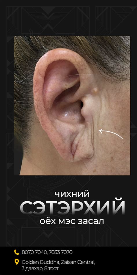 Golden Luxor Beauty Clinic ⚜ ЧИХНИЙ УРД ҮРЧЛЭЭ ЧИХНИЙ ХЭЛБЭР ЗАСАХ