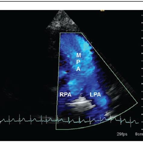Echocardiography With Color Flow Mapping Showing Normal Flow In Both Download Scientific