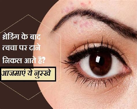 Beauty Care थ्रेडिंग के बाद होती है त्वचा पर दाने निकलने की समस्या