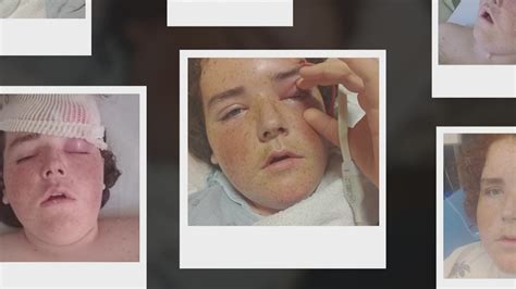 Dallas Teen Undergoes Brain Surgery After Sinus Infection Spreads