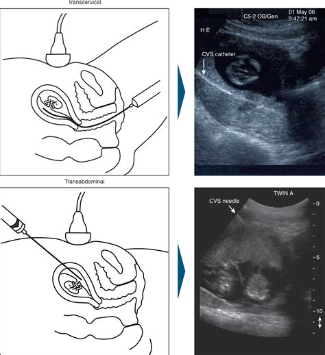 Prenatal Diagnosis And Counseling Clinical Tree