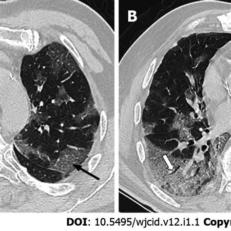 Axial Computed Tomography Scans 7 Days After Symptom Onset Show
