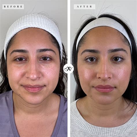 Before After Dermal Fillers Mid Face In New York NY SoVous Med Spa