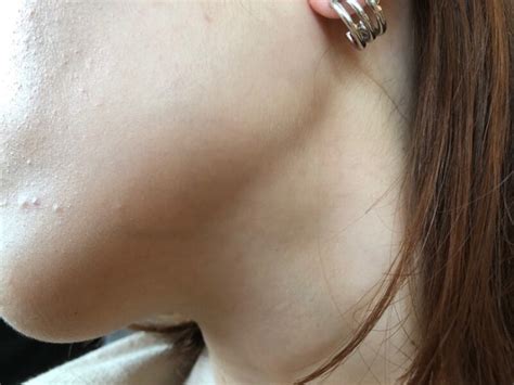 얼굴 실핏줄 터짐 원인과 예방법 네이버 블로그