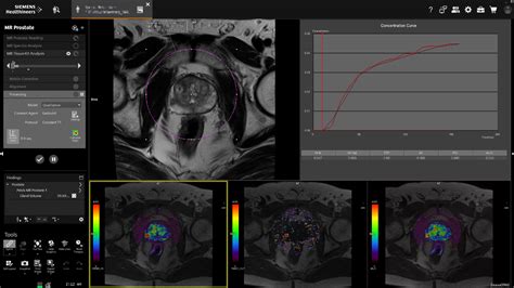Mr Prostate Ai Based Segmentation And Classification
