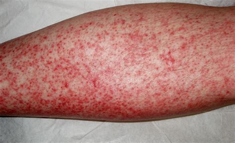 Dress Syndrome Rash