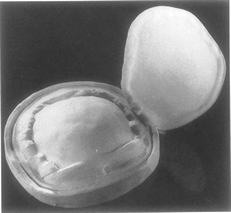 Cranial Defect Prosthesis And Clay Negative Of Patient 1 Download