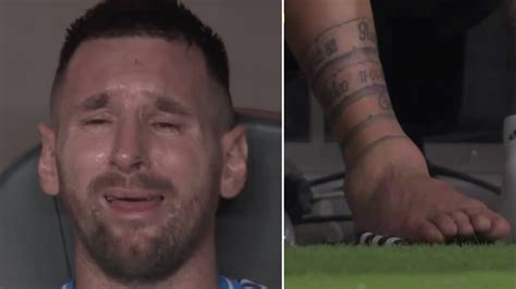 ¿qué Tan Grave Es Una Lesión Como La De Lionel Messi Y Cómo Será Su Rehabilitación