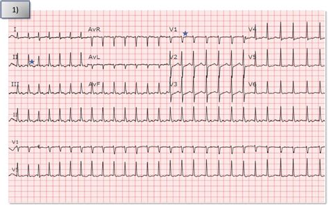 Paroxysmal Atrial Tachycardia With Block