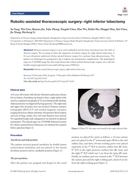 Pdf Robotic Assisted Thoracoscopic Surgery Right Inferior Lobectomy