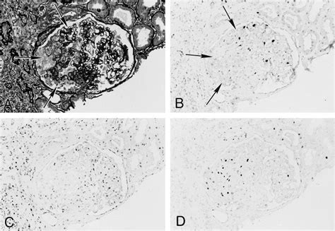 Serial Sections Of A Glomerulus Demonstrating The Cellular Variant Of Download Scientific