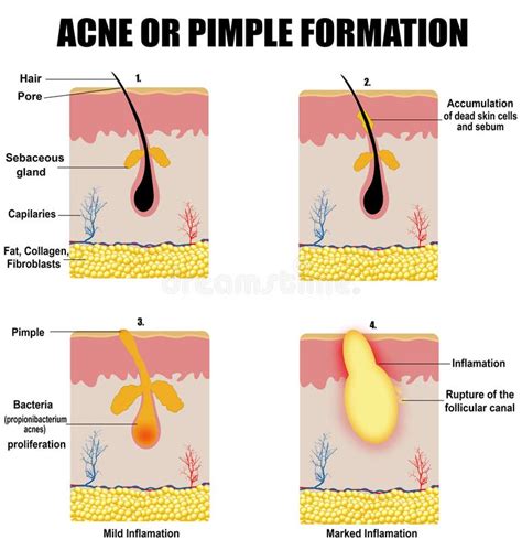 Inflammation Basic Stock Illustrations 32 Inflammation Basic Stock