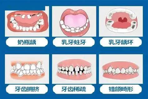 杭州牙齿矫正（杭州整牙）正畸攻略：牙齿矫正详细花费【多少钱】以及医院、医生选择。 知乎