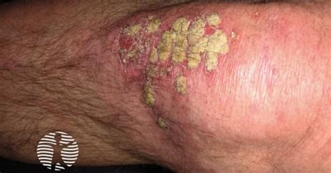 Dermnet® Chronic Plaque Psoriasis Image