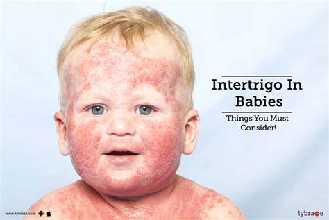 Intertrigo Breasts Treatment Intertrigo Intertrigo Candidiasis Snte