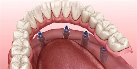 Prótese do Tipo Protocolo Odontomania