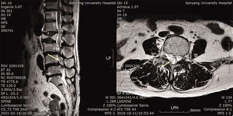 Redundant Nerve Root Syndrome On T2 Weighted Magnetic Resonance Imaging