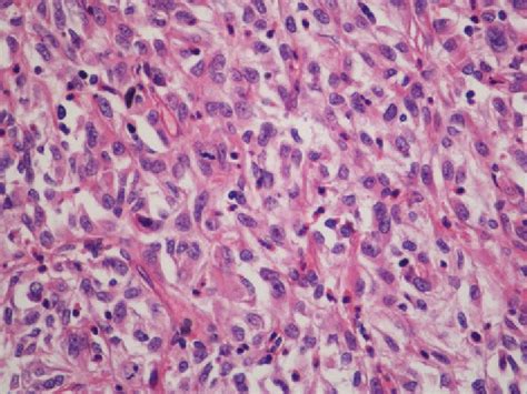Sarcomatoid Urothelial Carcinoma Spindle Tumor Cells With High Grade