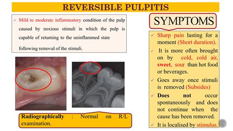 Diagnosis Of Pulppptx