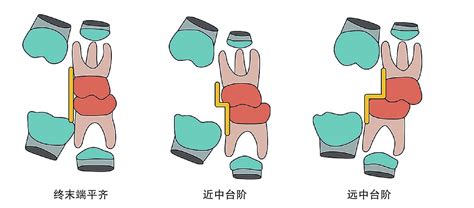二终末平面 儿童错 牙合 畸形早期矫治 医学