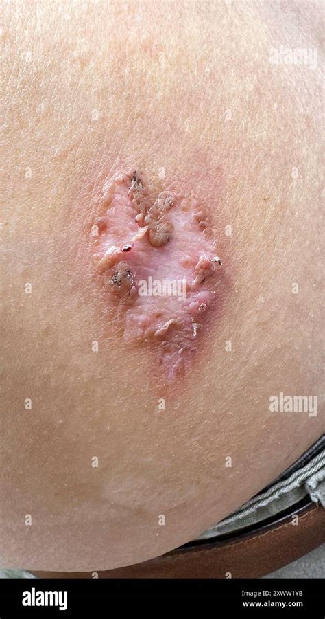 Not To Be Used For Advertising Or In A Defamatory Context Healing Pyoderma Gangrenosum On A