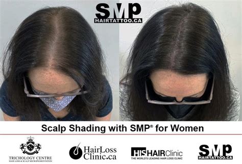 Scalp Micropigmentation Women Non Invasive And Cost Effective Hair