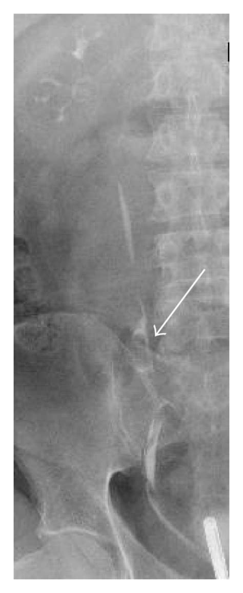 Retrograde Pyeloureterography Revealing Right Mid Ureteral Filling Defect Download Scientific