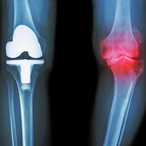 Wanneer Is Het Nodig Om Een Knieprothese Te Vervangen Alles Over De