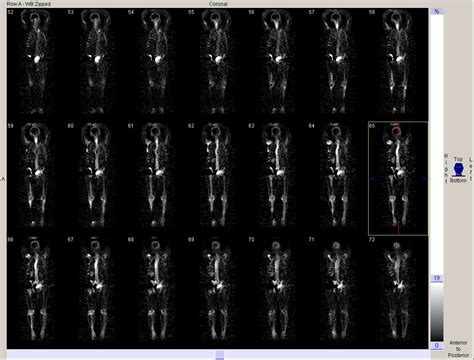 Nuclear Medicine Technology Program Whole Body Bone Spect