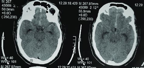 Ncct Brain Showing Sah In The Interhemispheric Fissure And Bilateral