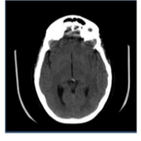 Source Ct Image Of A Patient Diseased By A Sarcoma Download