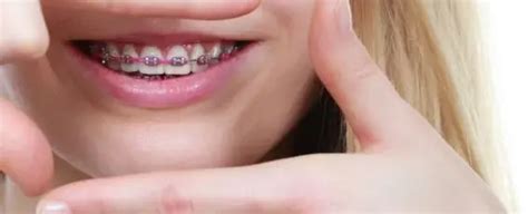 Quanto custa um aparelho dentário Descubra agora mesmo Dentista em Ceilândia Implante Dentário