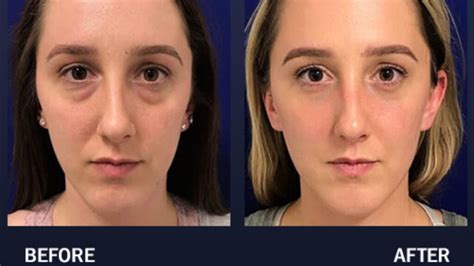 Under Eye Fat Graft Korea Costs Clinics June 2024