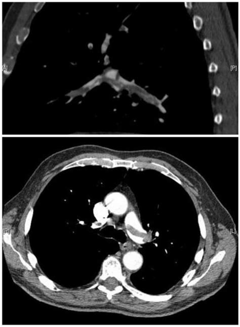 Pulmonary Embolism Concise Medical Knowledge