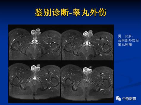 睾丸表皮样囊肿医学界 助力医生临床决策和职业成长