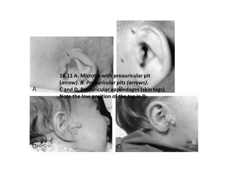 Embryology 18 Ear Pptx Ear Nose And Throat Conditions Diseases