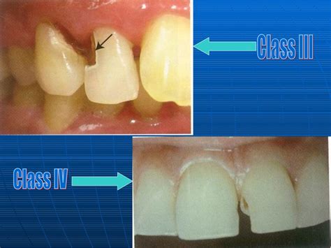 Classification Of Dental Caries