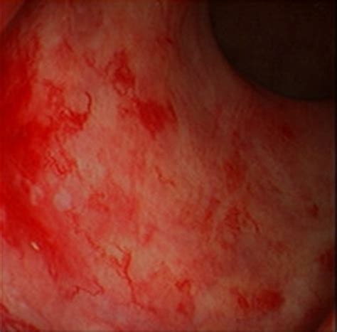 急性化脓性的胃炎的图片有来医生