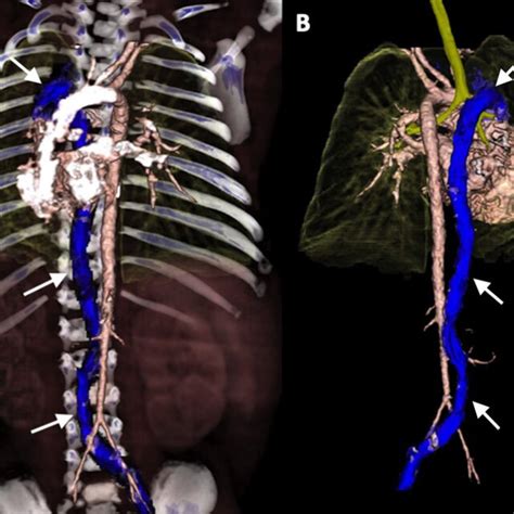 3d Volume Rendering Reconstructions Of Computed Tomography Angiography Download Scientific