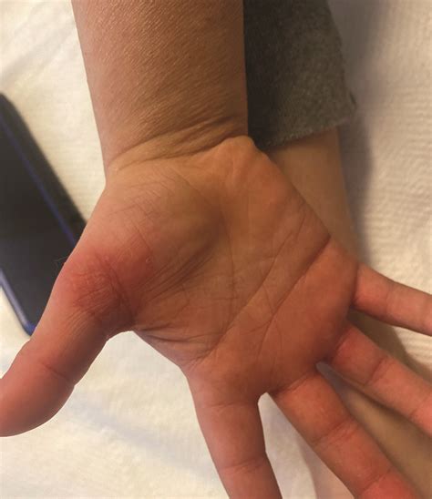 Disseminated Varicella Zoster Virus And Herpes Zoster Virus Infection