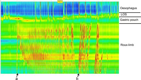 High Resolution Manometry Study Subject Woman Years Note The