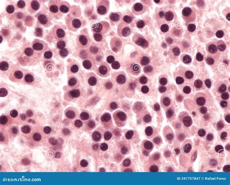 Multiple Myeloma In The Bone Marrow Histology Stock Image Image Of