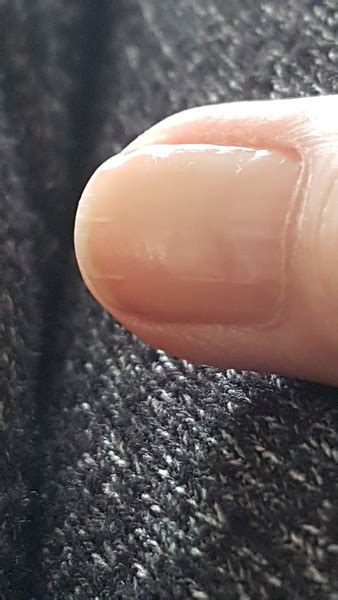 Finger Nails Splitting Vertically Gransnet
