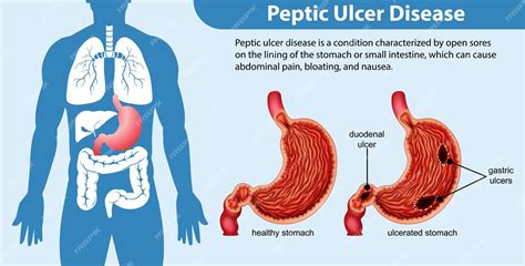 Free Vector Peptic Ulcer Disease Infographic